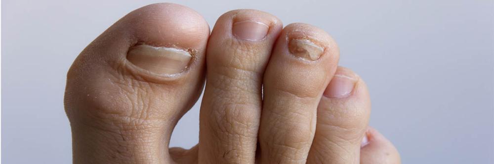 Toe Separators for Overlapping Toes