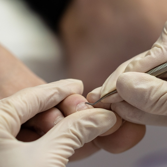 Podiatry Probes for Nail Care