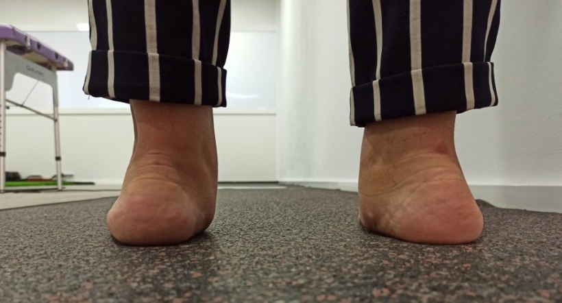 What is pes planus caused by?