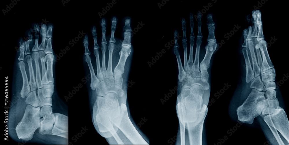 Demystifying the Foot Fracture Boot | Algeos